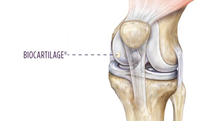 Knee Cartilage Loss Treatments A Comprehensive Guide | Health & Style Plus