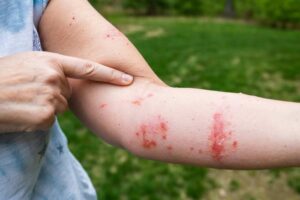 Plants That Cause Rashes A Comprehensive Guide | Health & Style Plus