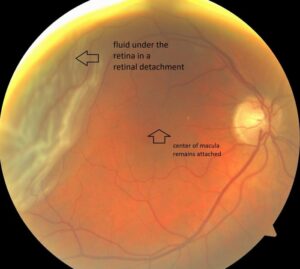 Fluid Behind the Retina A Comprehensive Guide | Health & Style Plus