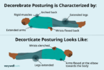 Decorticate vs Decerebrate Posturing A Deep Dive | Health & Style Plus
